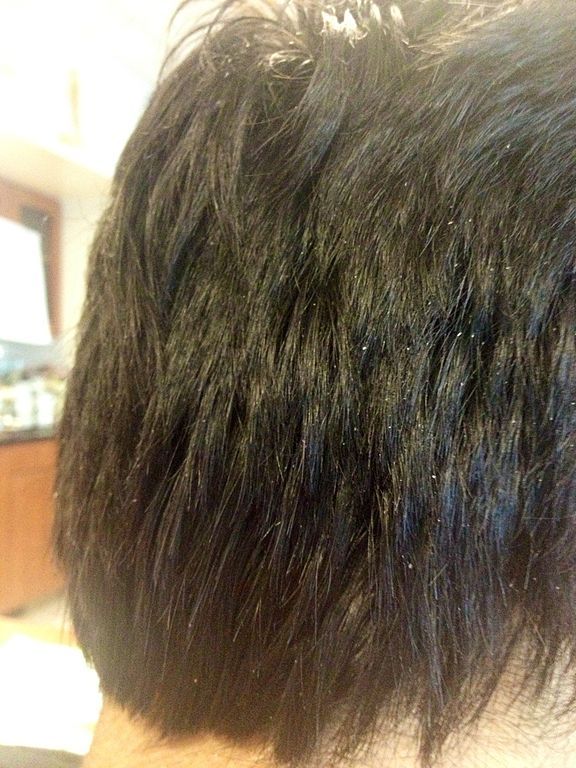 Dandruff Causes Symptoms Homeopathic Treatment Dandruff Causes Symptoms Homeopathic Treatment