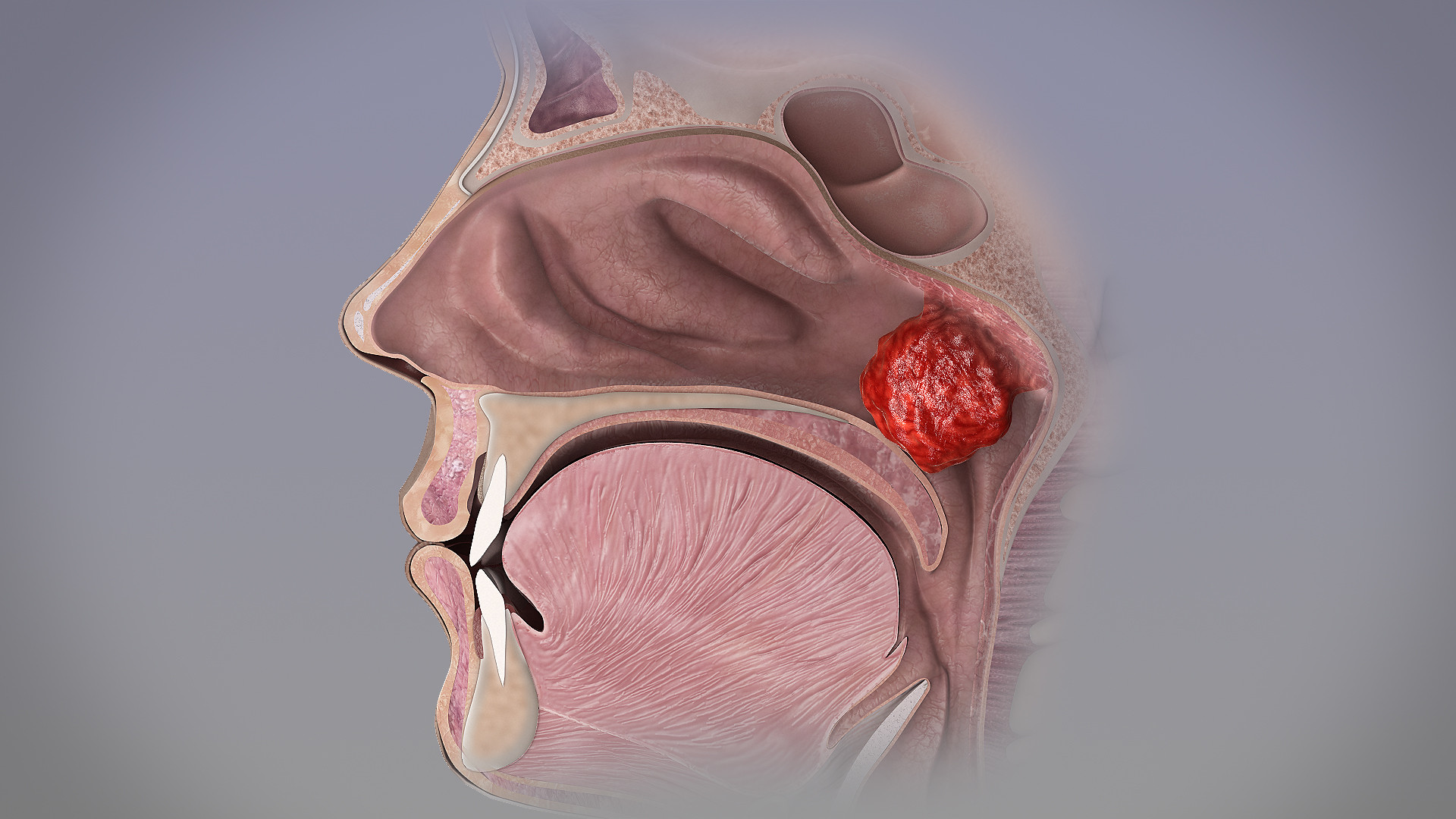 Adenoid Hypertrophy Causes Homeopathic Treatment Adenoid Hypertrophy Causes Homeopathic Treatment