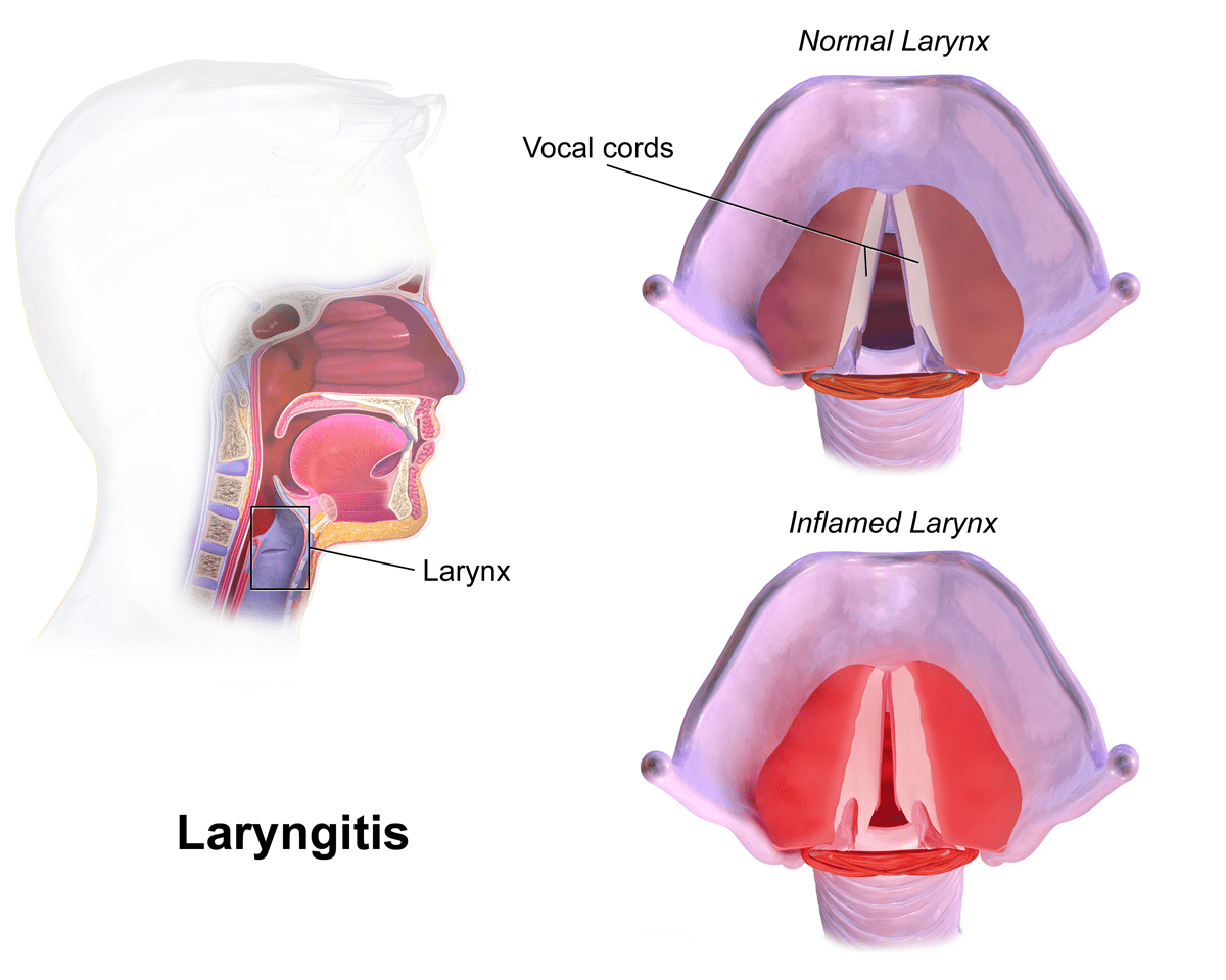 Laryngitis Causes Sign Symptoms Homeopathic Treatment Laryngitis Causes Sign Symptoms Homeopathic Treatment